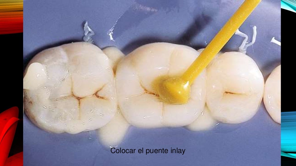 Incrustaciones inlay, onlay y overlay