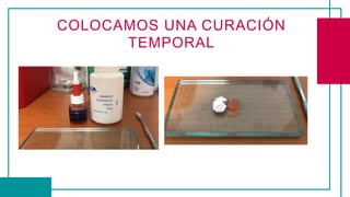 Incrustacion estetica | PPTX
