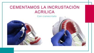 Incrustacion estetica | PPTX