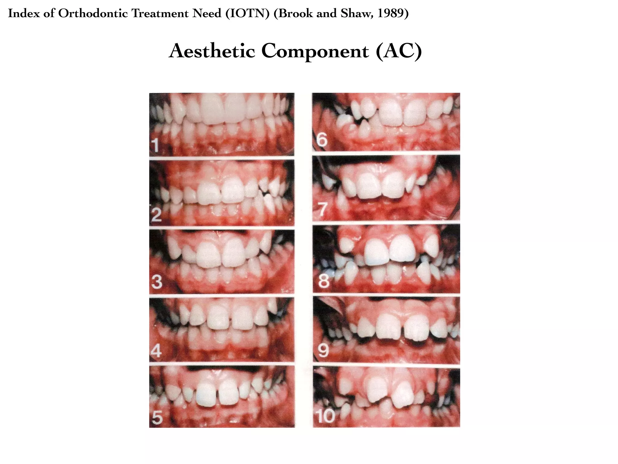 Index of Orthodontic Treatment Need (IOTN) | PDF