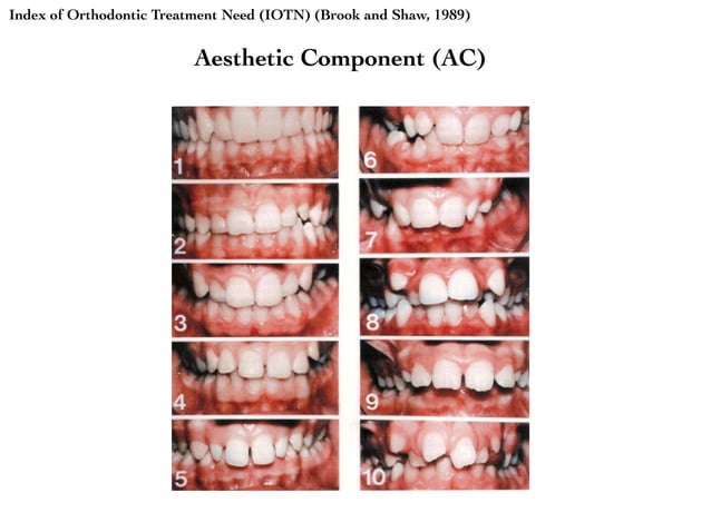 Index of Orthodontic Treatment Need (IOTN) | PDF