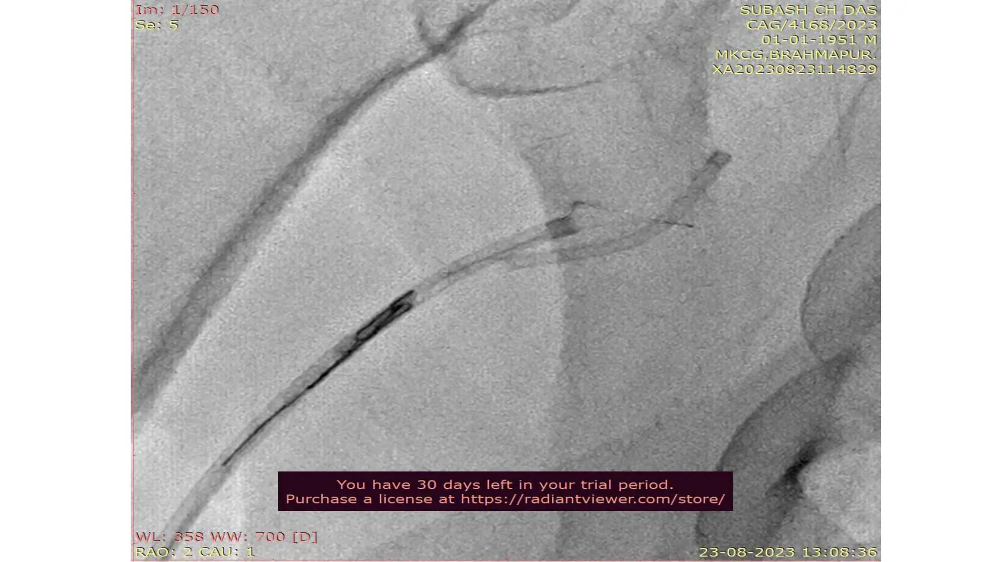 A broken catheter - Nightmare in cathlab | PPTX