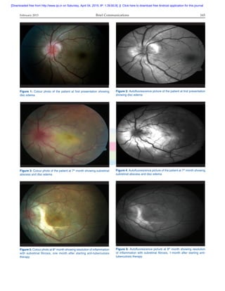 Subretinal tubercular abscess presenting as disc edema