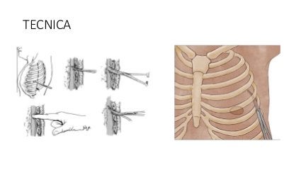 INDICACION DE TORACOSTOMIA Y COLOCACIÓN DE SONDA ENDOPLEURAL.pptx