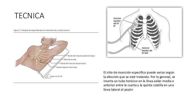 INDICACION DE TORACOSTOMIA Y COLOCACIÓN DE SONDA ENDOPLEURAL.pptx