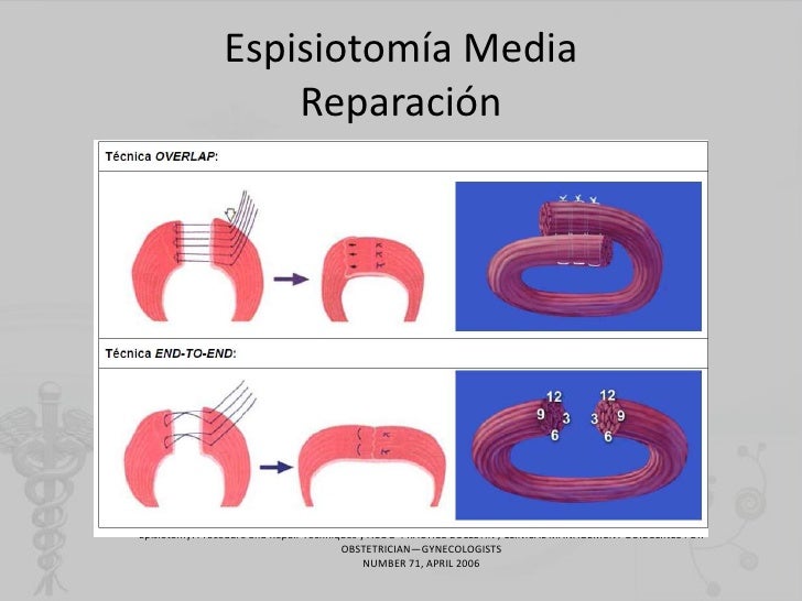 Episiotomia y episiorrafia