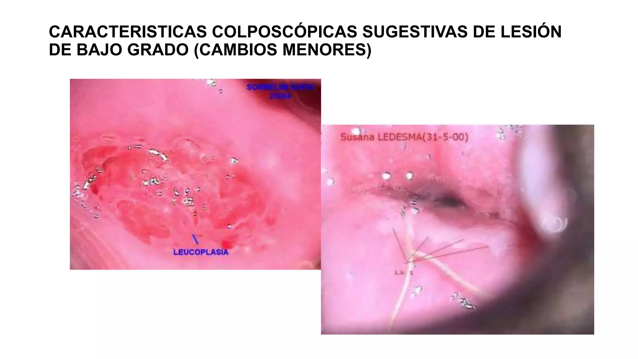 INDICACIONES PARA COLPOSCOPIA.pptx