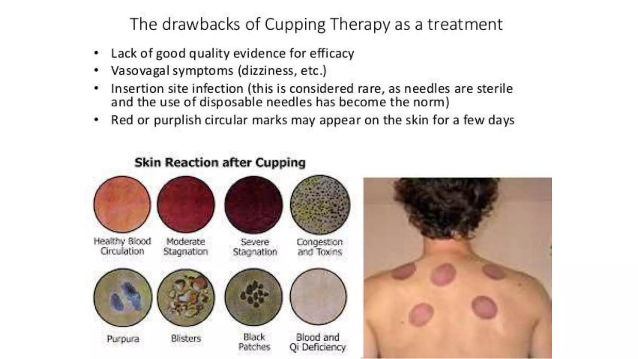 CUPPING - Indication, Contraindication & Safety aspect | PPTX