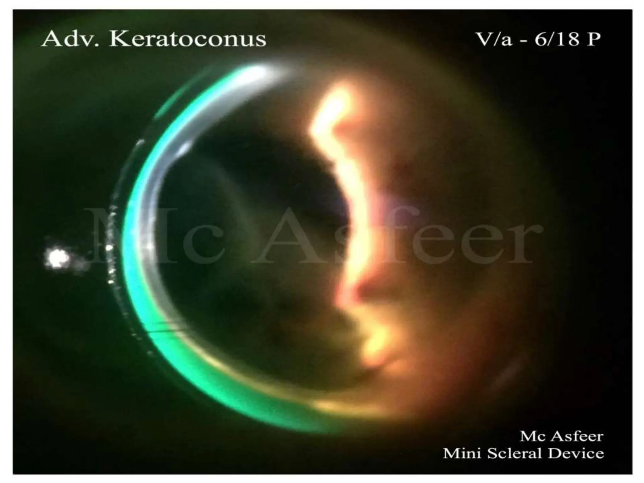 Indication of RGP Lens in corneal abnormalties.pptx