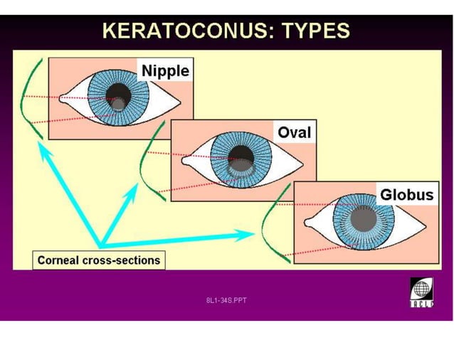 Indication of RGP Lens in corneal abnormalties.pptx