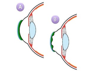Indication of RGP Lens in corneal abnormalties.pptx