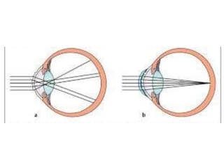 Indication of RGP Lens in corneal abnormalties.pptx