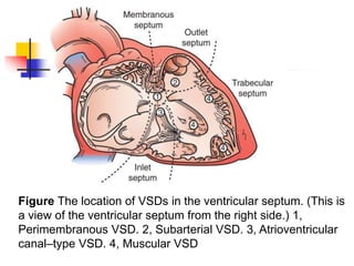 Indication of surgery in cong. heart disease | PPT