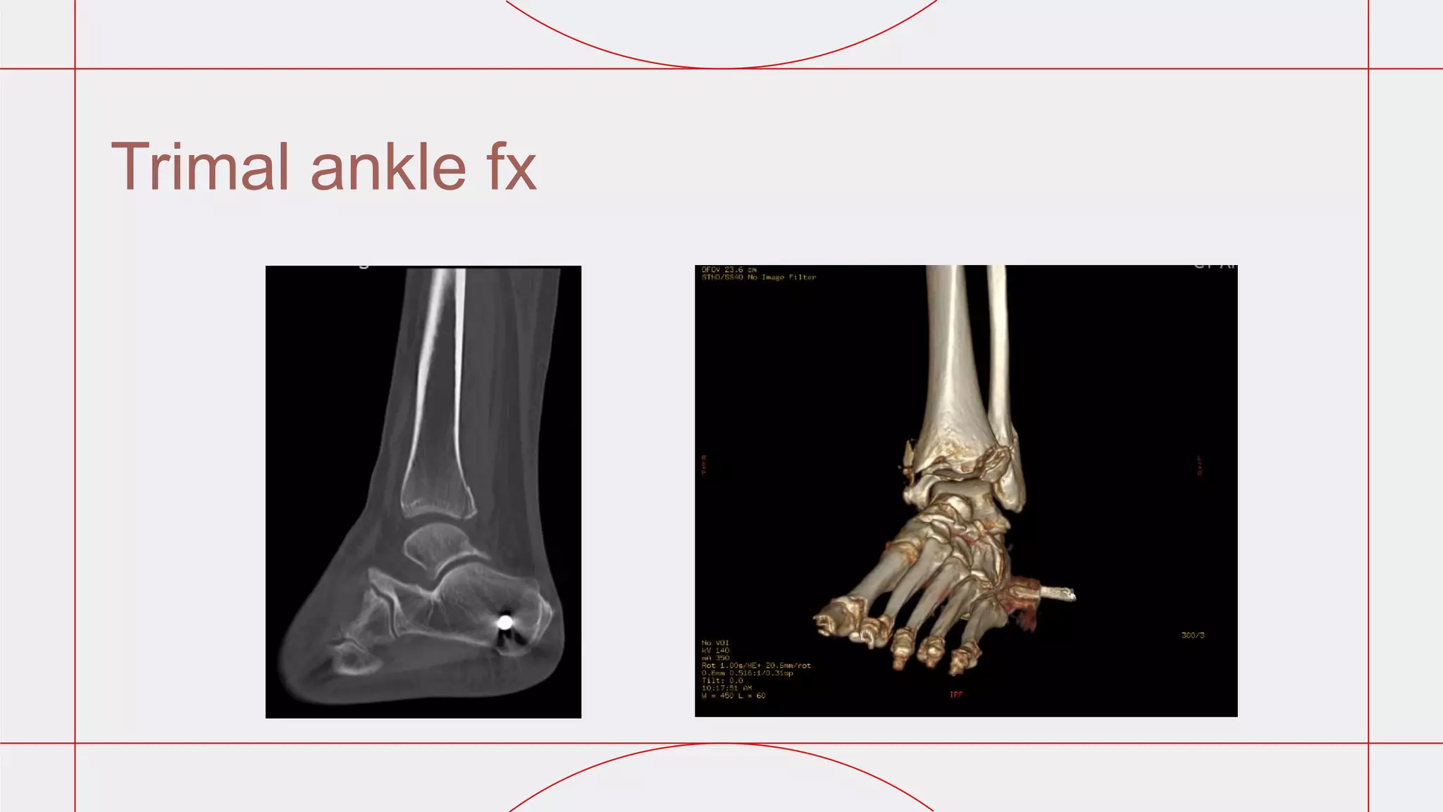 Indications - Ankle fx.pptx