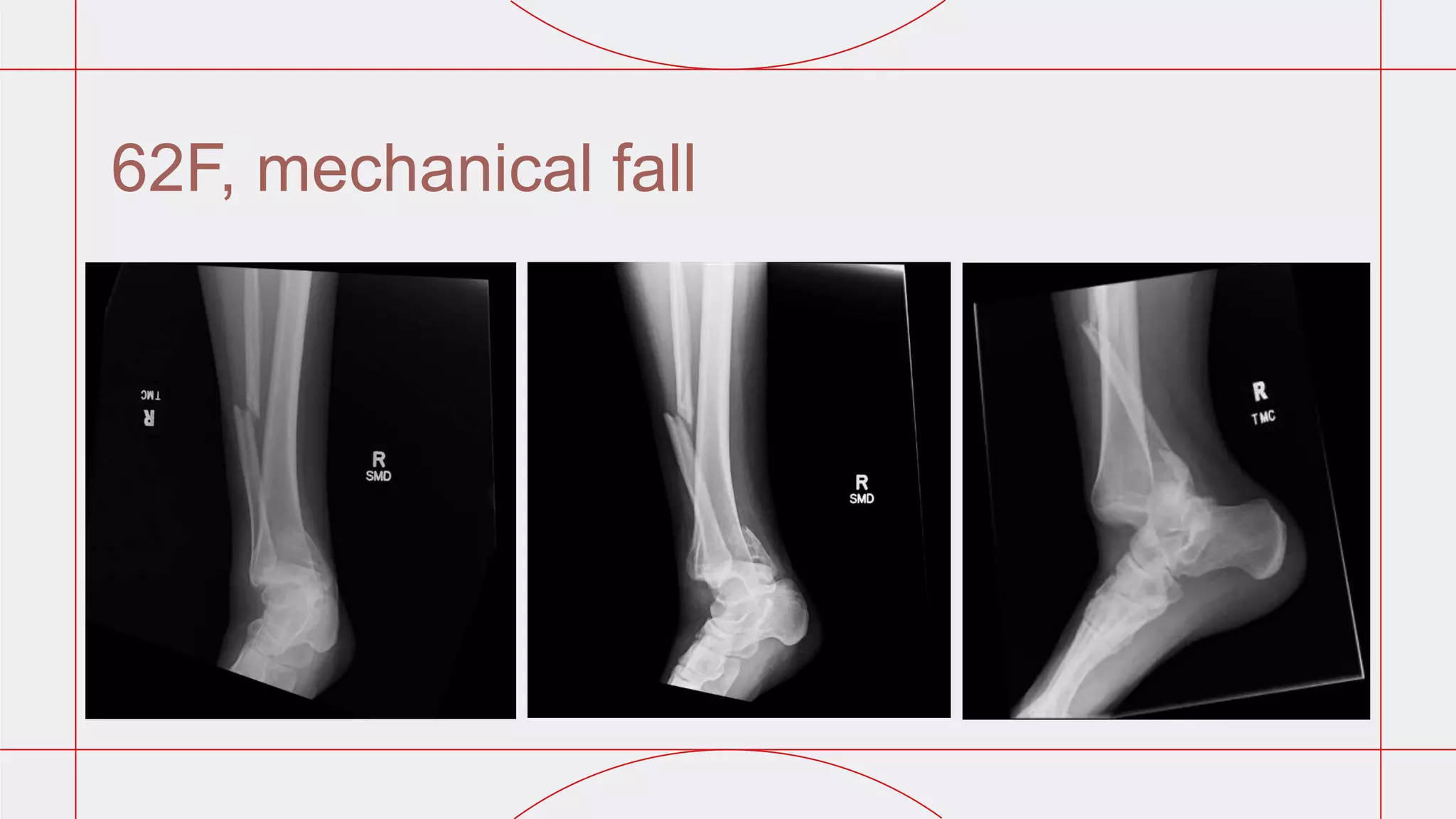 Indications - Ankle fx.pptx