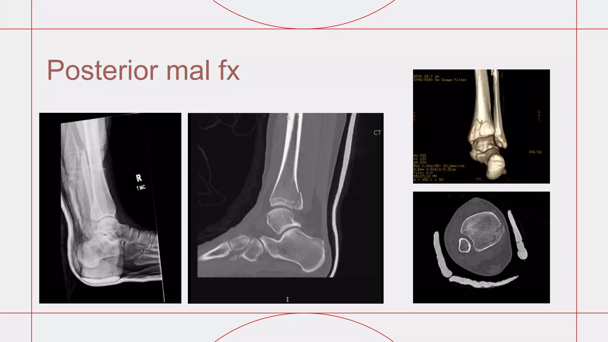 Indications - Ankle fx.pptx