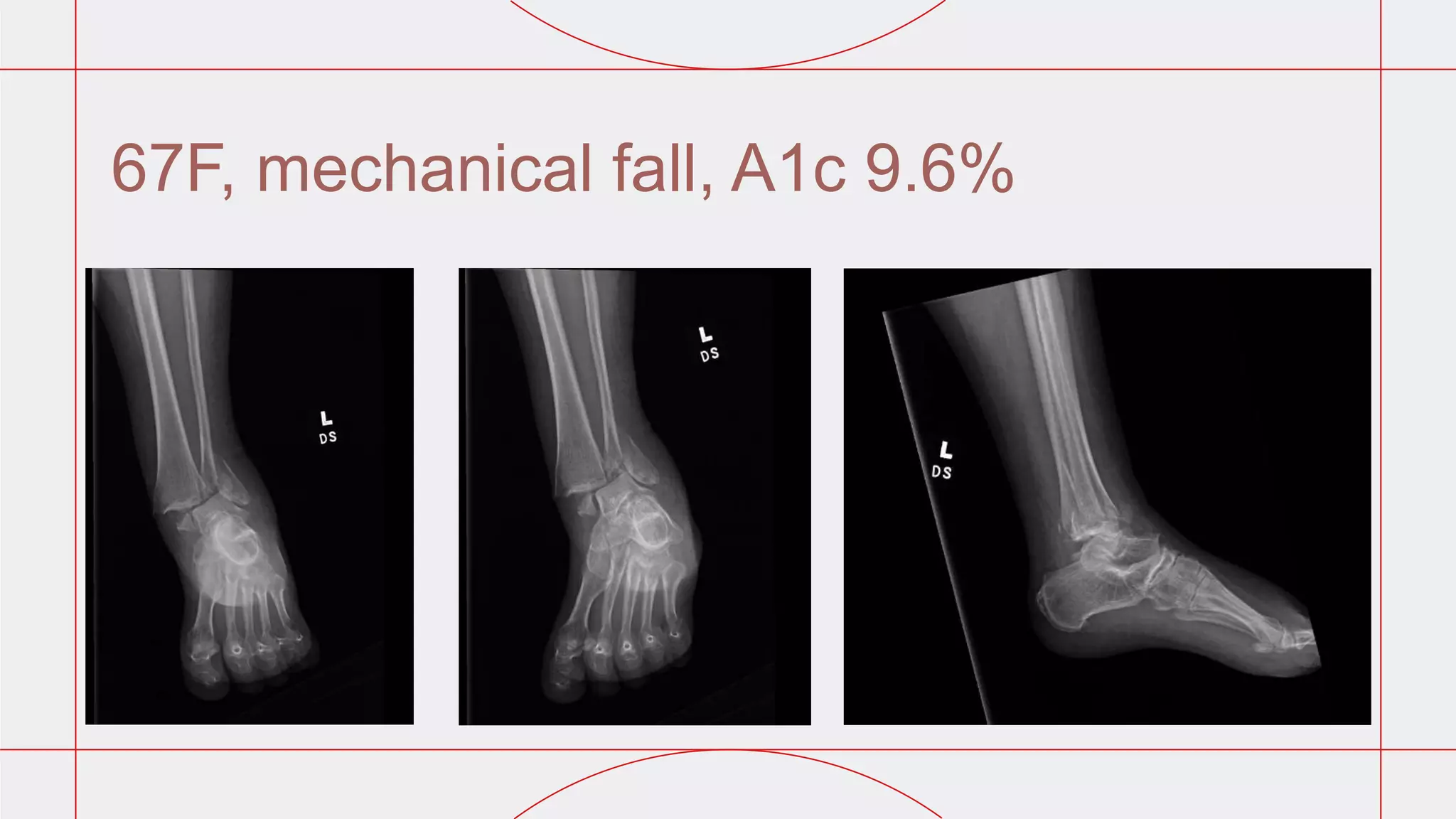 Indications - Ankle fx.pptx