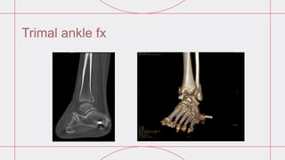 Indications - Ankle fx.pptx