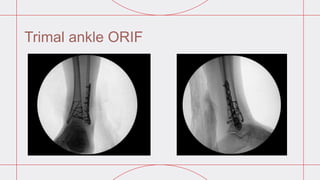 Indications - Ankle fx.pptx