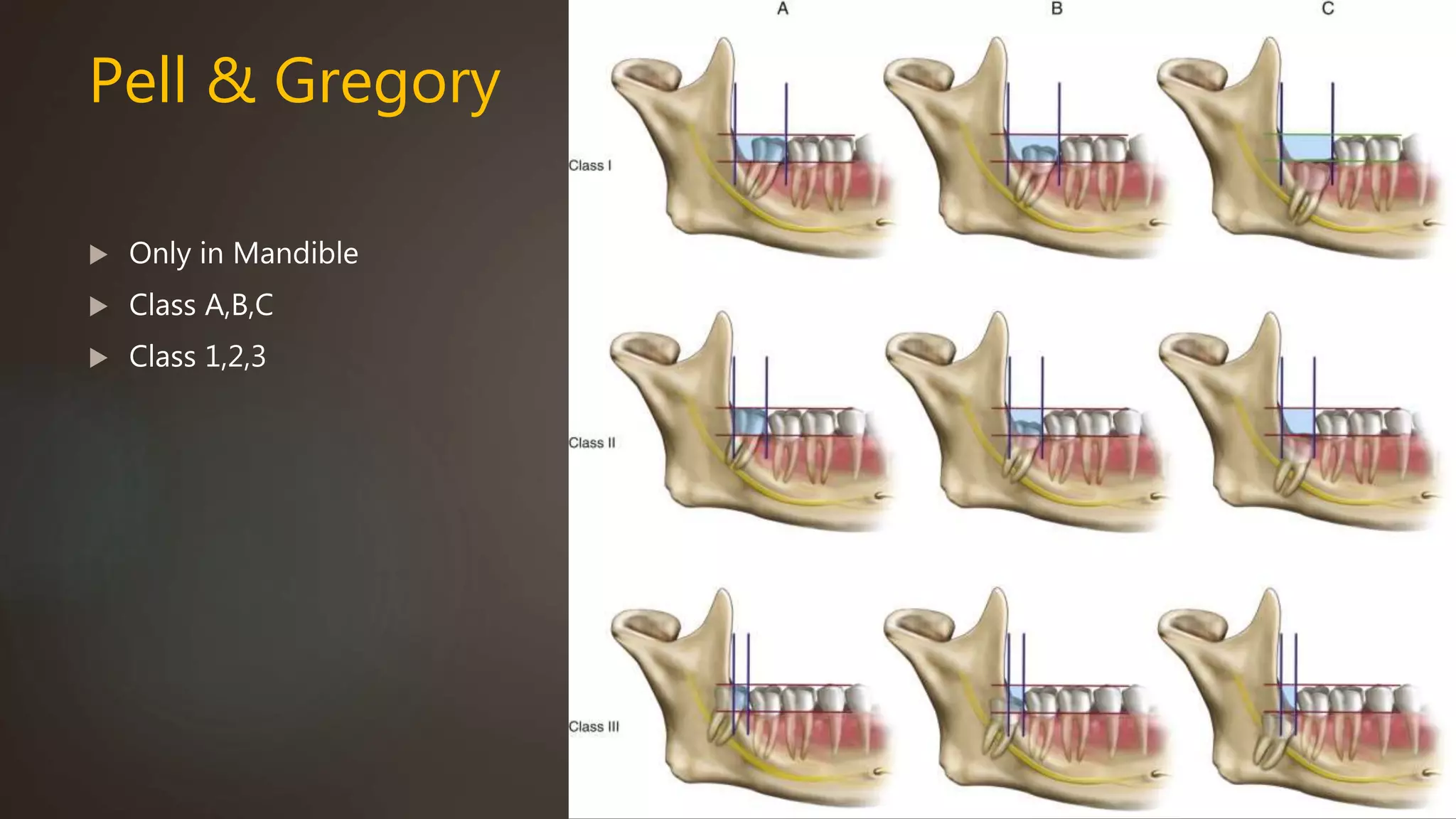 Indications and contraindications of 3rd molar | PPTX | Dental Health ...