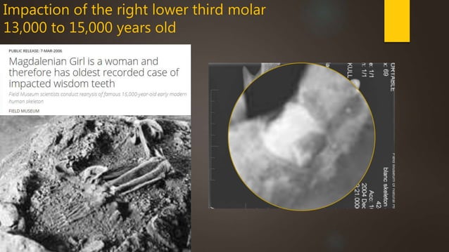 Indications and contraindications of 3rd molar | PPTX | Dental Health ...