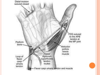 Indications and principles of tendon transfer | PPTX