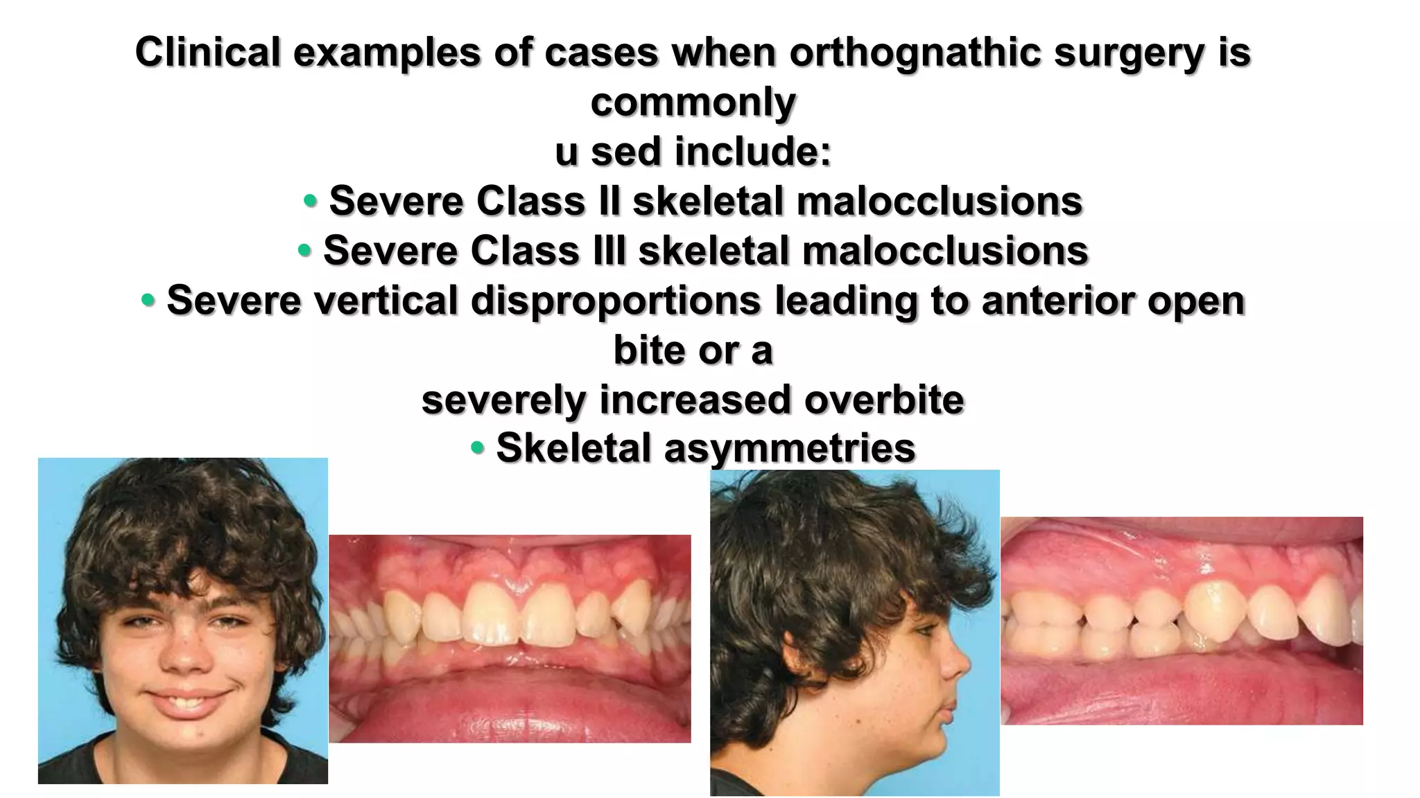 Indications of orthognathic surgery and surgical procedures | PPTX