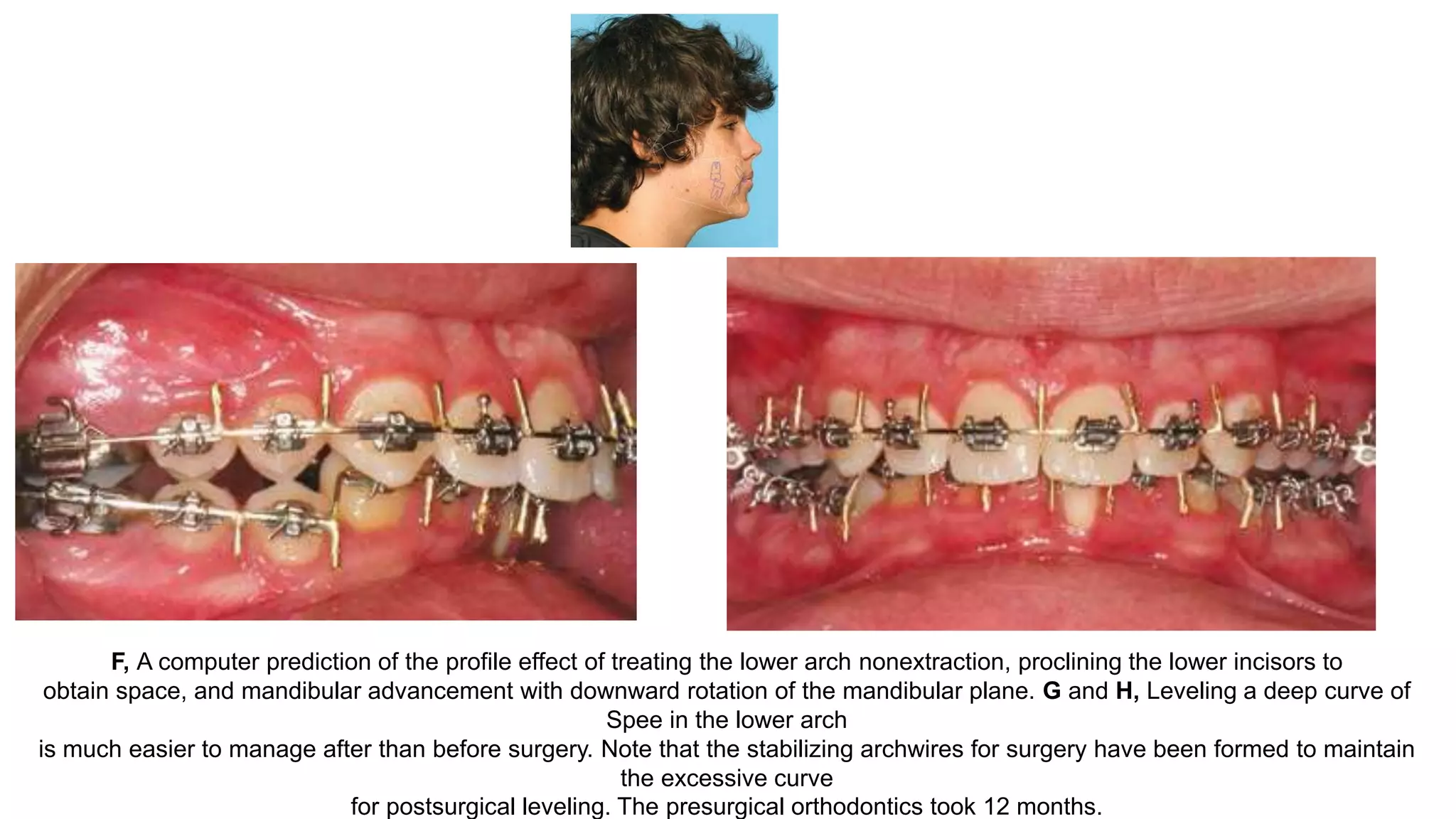 Indications of orthognathic surgery and surgical procedures | PPTX