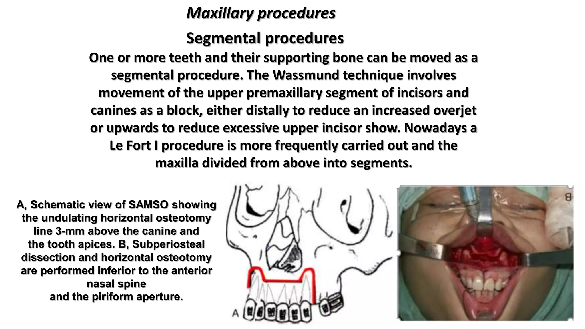 Indications of orthognathic surgery and surgical procedures | PPTX