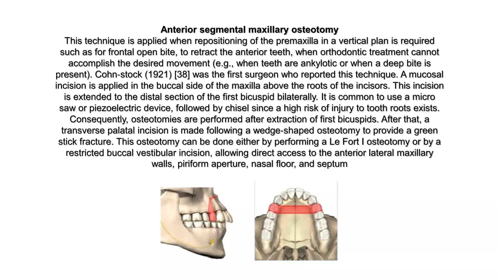 Indications of orthognathic surgery and surgical procedures | PPTX