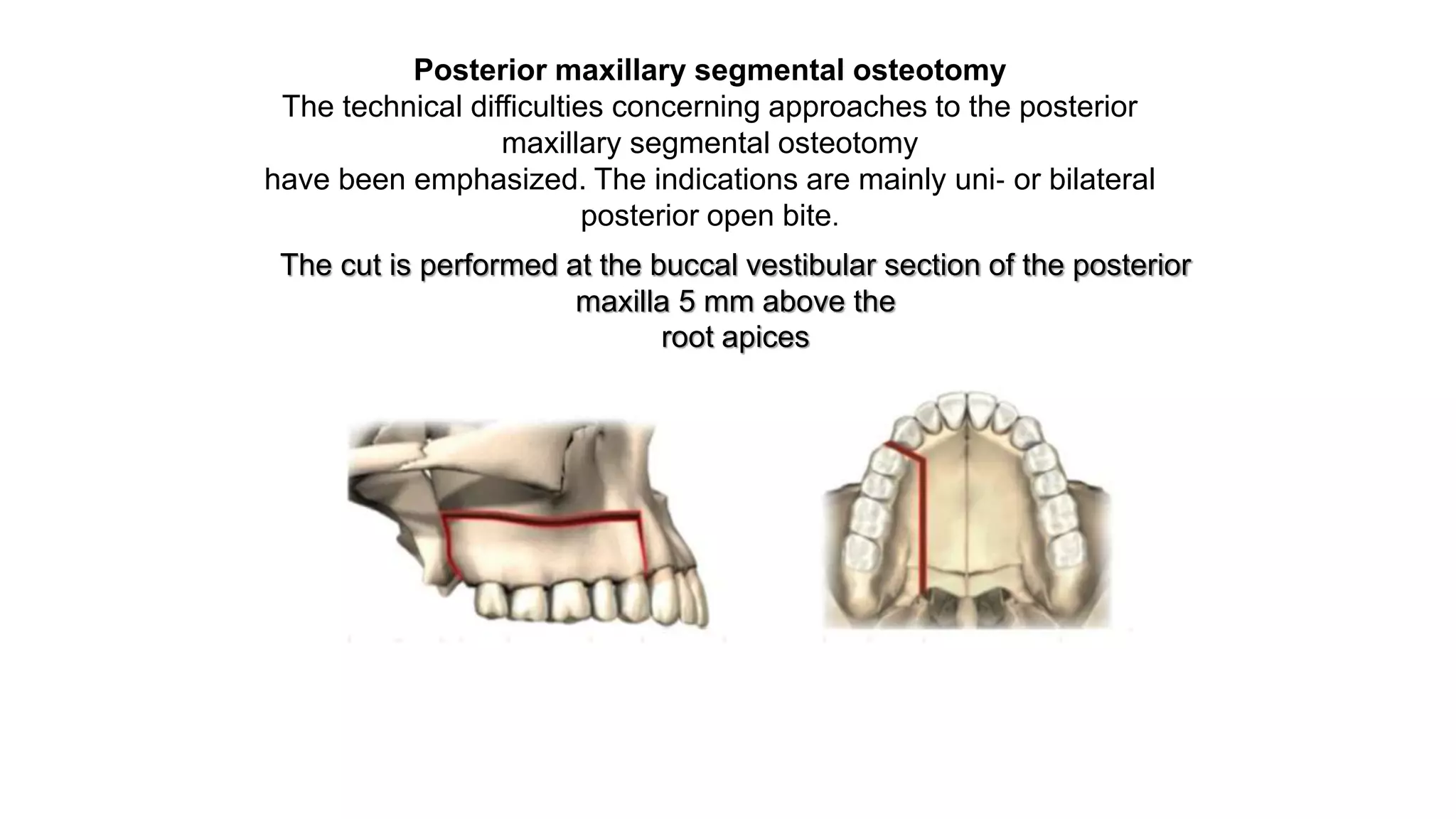 Indications of orthognathic surgery and surgical procedures | PPTX