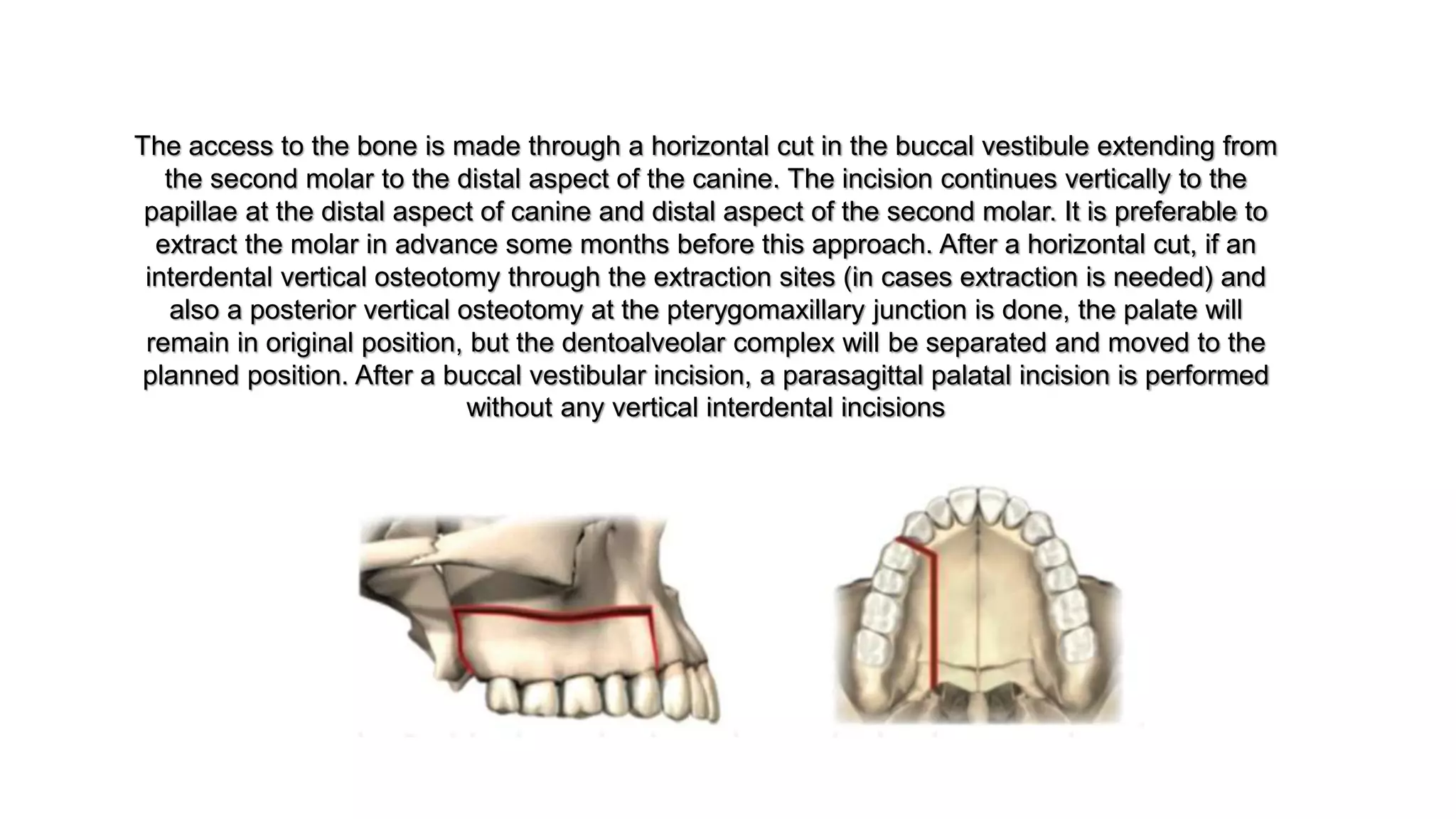 Indications of orthognathic surgery and surgical procedures | PPTX