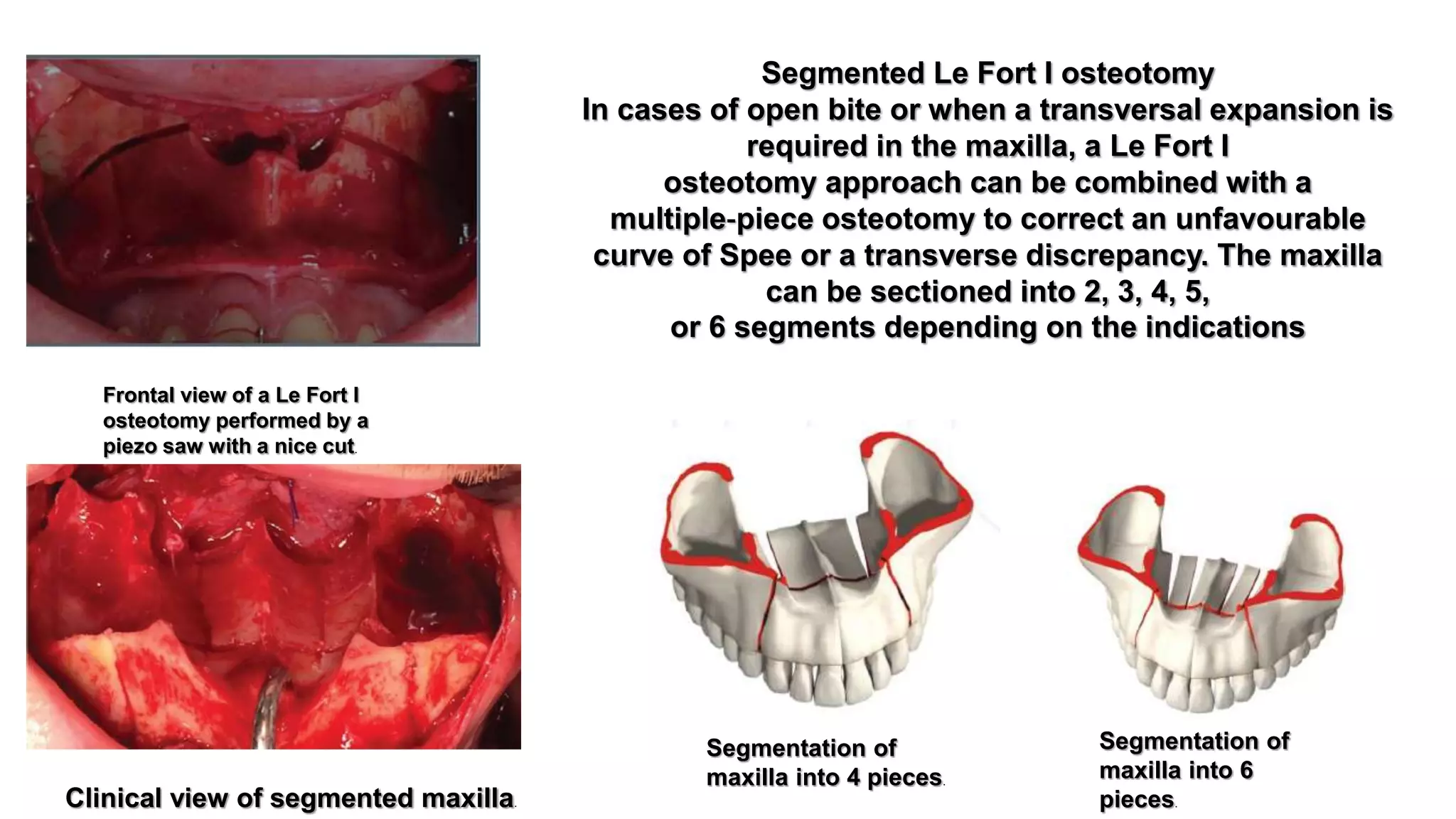 Indications of orthognathic surgery and surgical procedures | PPTX