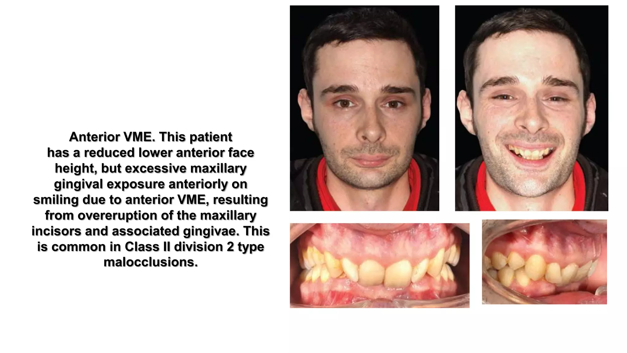 Indications of orthognathic surgery and surgical procedures | PPTX