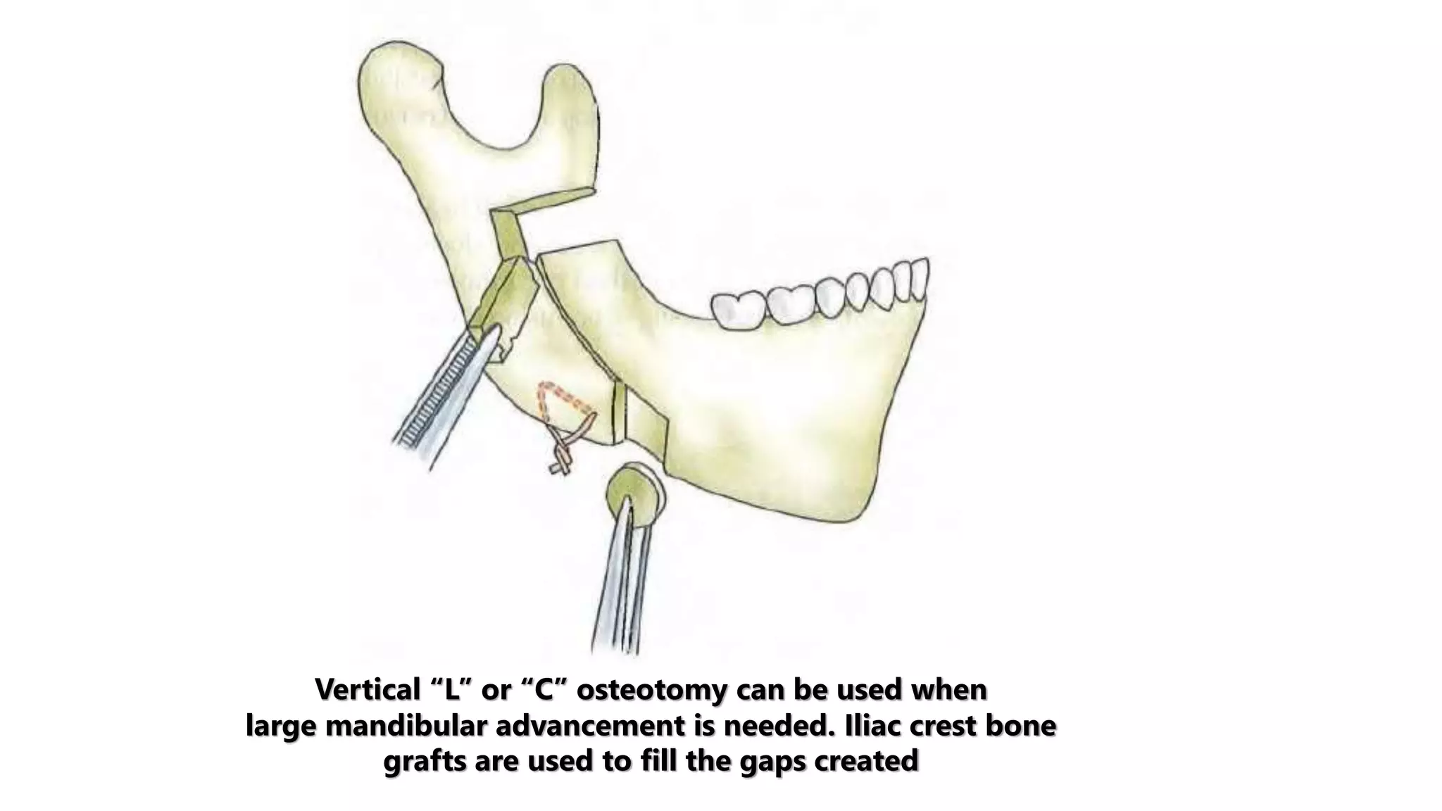Indications of orthognathic surgery and surgical procedures | PPTX