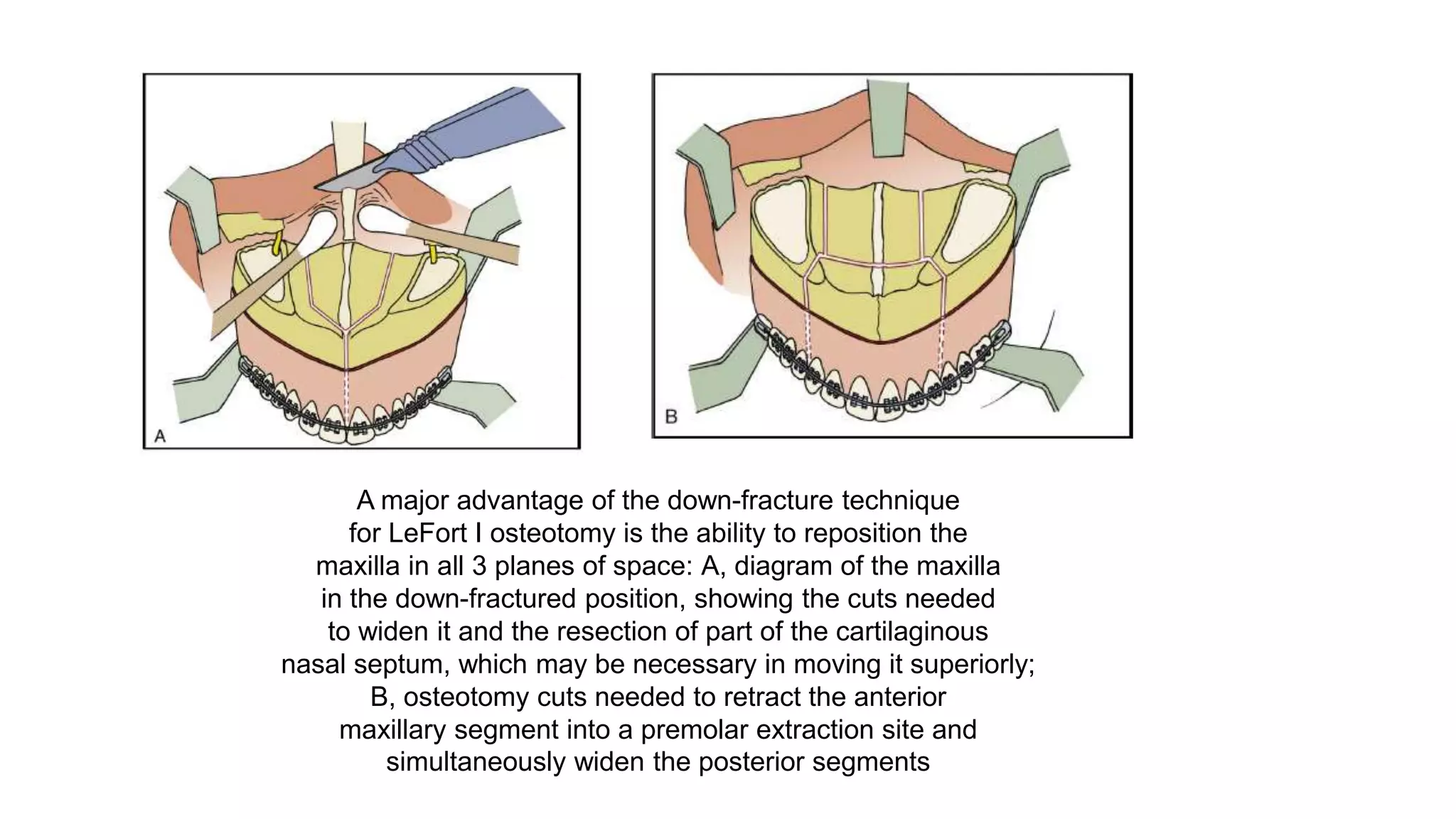 Indications of orthognathic surgery and surgical procedures | PPTX