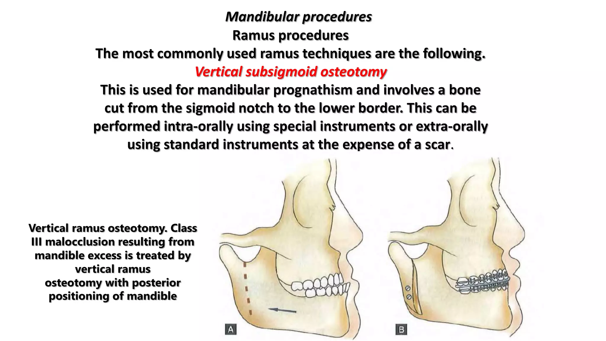 Indications of orthognathic surgery and surgical procedures | PPTX
