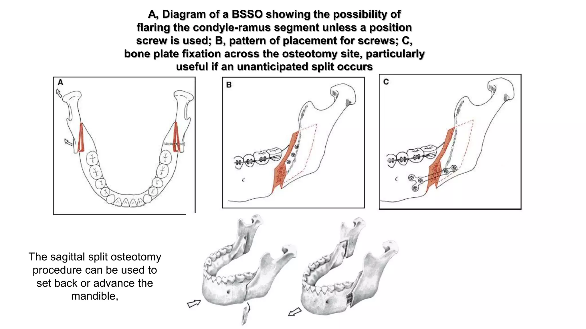 Indications of orthognathic surgery and surgical procedures | PPTX