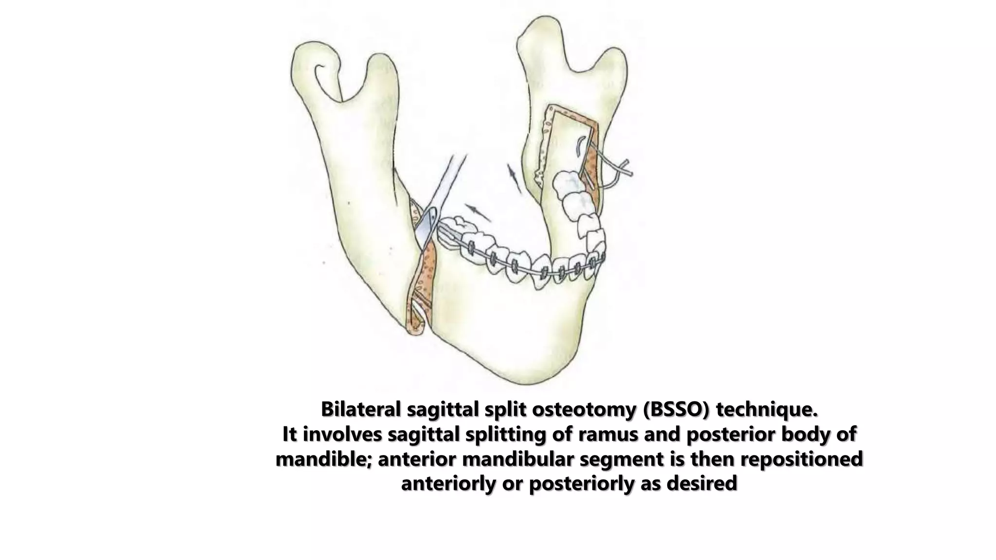 Indications of orthognathic surgery and surgical procedures | PPTX