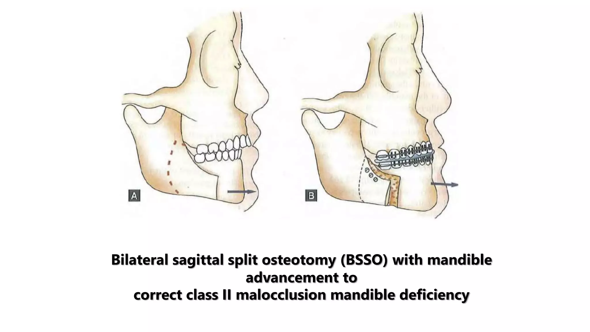 Indications of orthognathic surgery and surgical procedures | PPTX