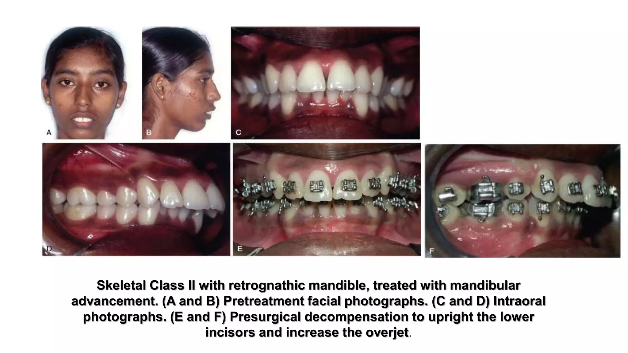 Indications of orthognathic surgery and surgical procedures | PPTX