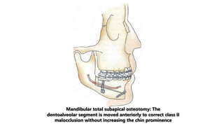 Indications of orthognathic surgery and surgical procedures | PPTX