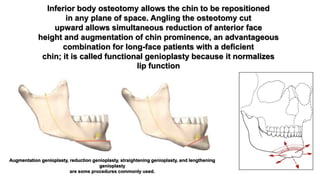 Indications of orthognathic surgery and surgical procedures | PPTX