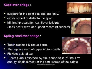 Spring Cantilever Bridge Dental