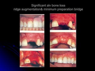 Indications Contraindications and Classification of Bridges 2.pptx