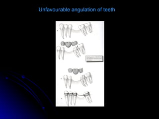 Indications Contraindications and Classification of Bridges 2.pptx