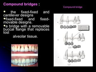 Indications Contraindications and Classification of Bridges 2.pptx