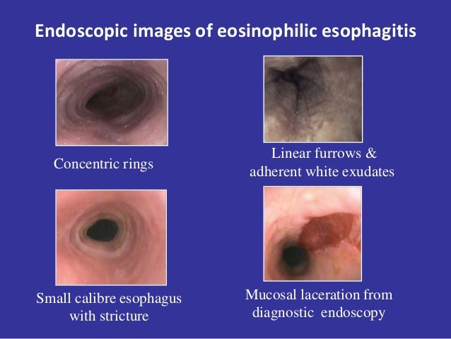 Indications of proton pump inhibitors