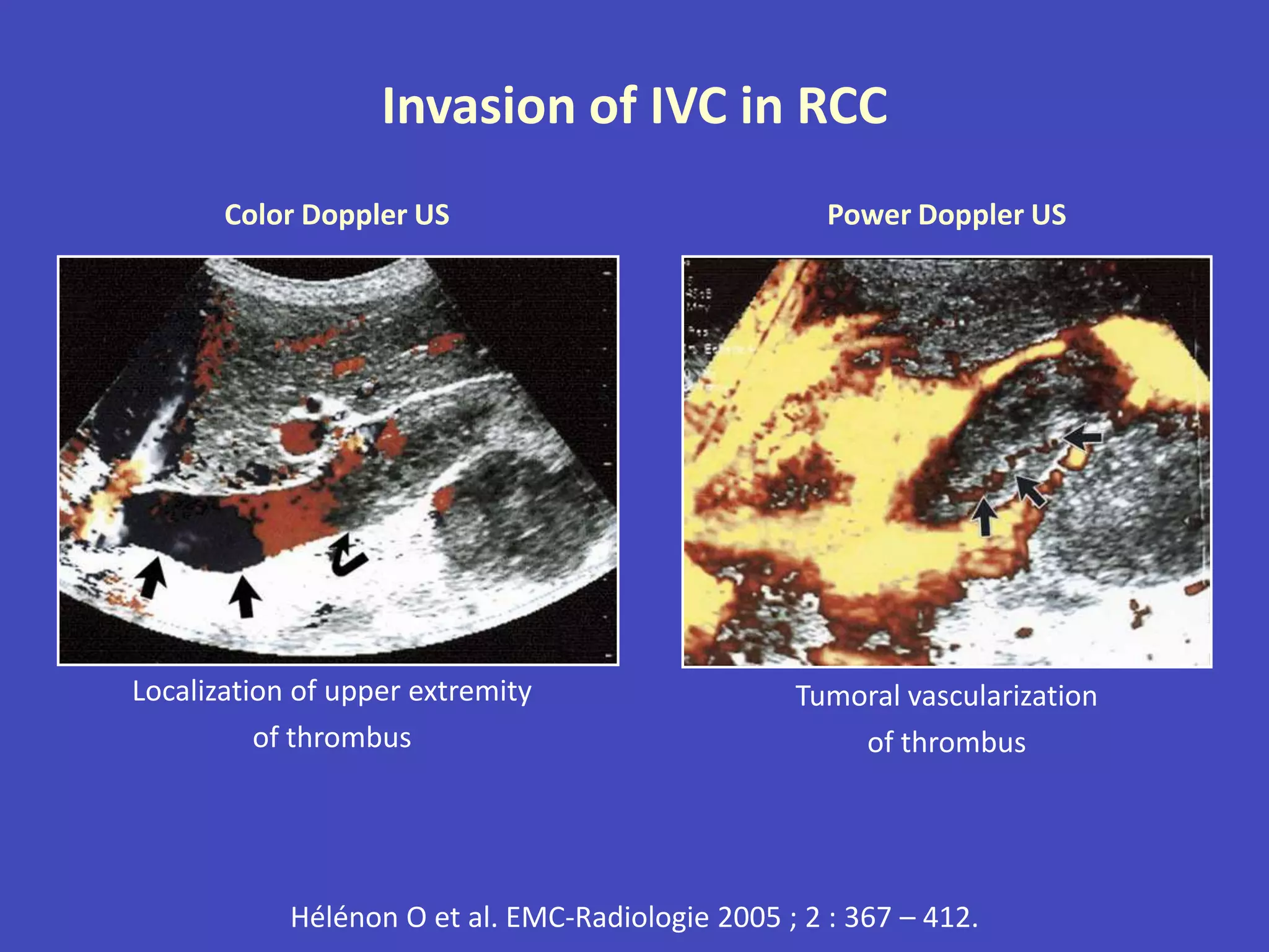 Indications of renal doppler ultrasound 3 | PPTX