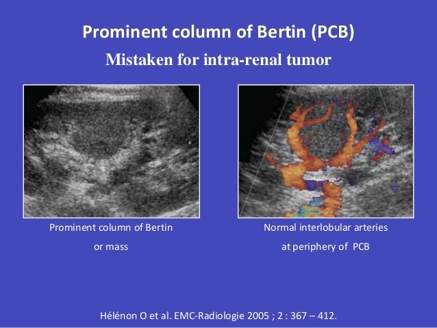 Indications of renal doppler ultrasound 3
